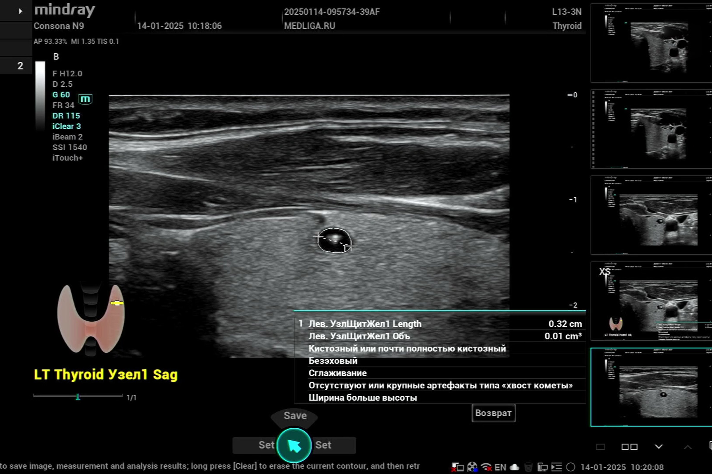 УЗИ щитовидной железы и функция Smart Thyroid на Mindray Consona N9 ...