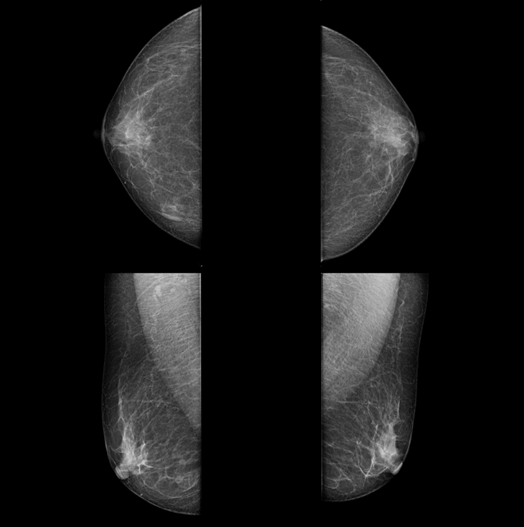Маммограф GENORAY MX-600 - купить в Москве по выгодной цене на MEDLIGA