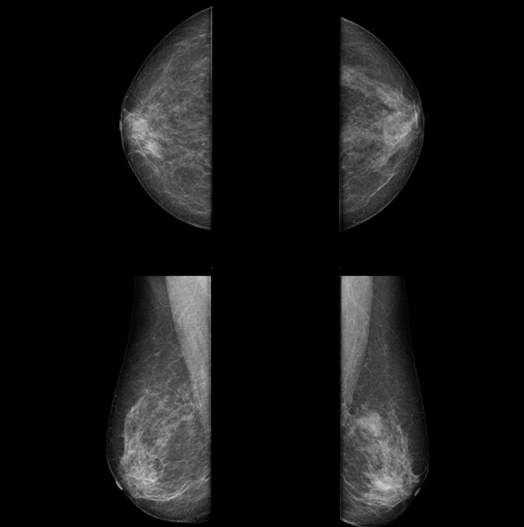 Маммограф GENORAY MX-600 - купить в Москве по выгодной цене на MEDLIGA