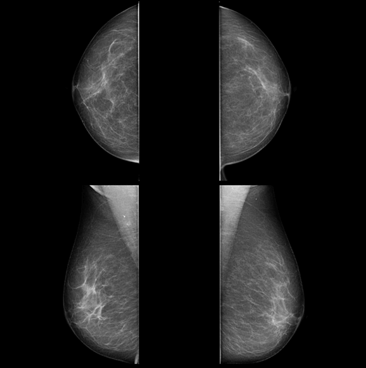 Маммограф GENORAY MX-600 - купить в Москве по выгодной цене на MEDLIGA