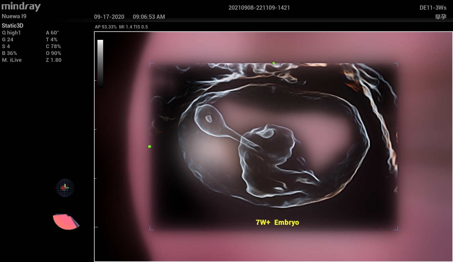 УЗИ аппарат Mindray Imagyn I9 - купить в Москве по выгодной цене на MEDLIGA