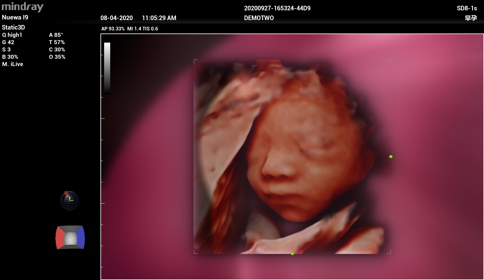 УЗИ аппарат Mindray Imagyn I9 - купить в Москве по выгодной цене на MEDLIGA