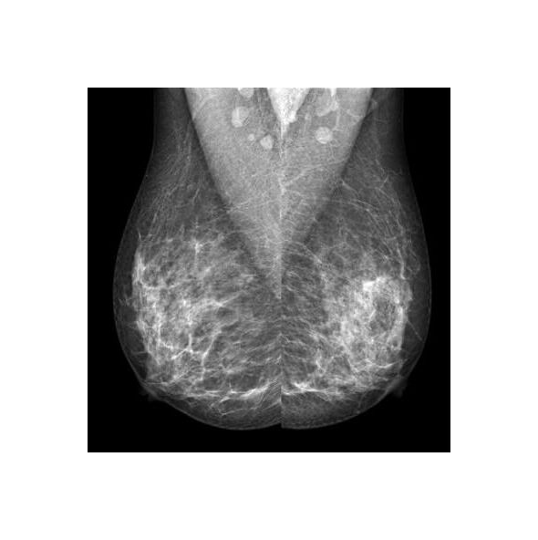 Маммограф GENORAY MX-600 - купить в Москве по выгодной цене на MEDLIGA