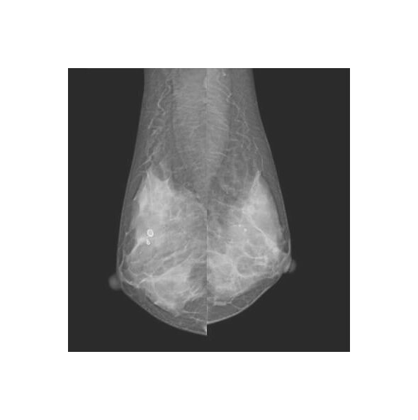 Маммограф GENORAY MX-600 - купить в Москве по выгодной цене на MEDLIGA