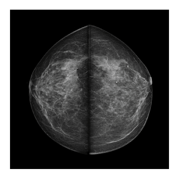 Маммограф GENORAY MX-600 - купить в Москве по выгодной цене на MEDLIGA